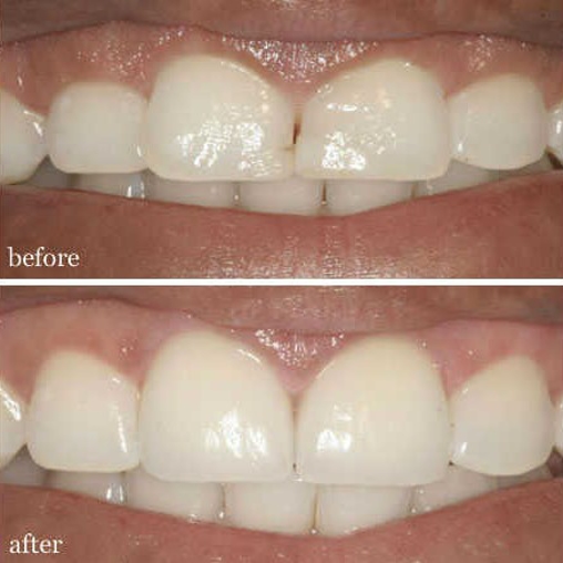 Before and After | Greenville Dentist