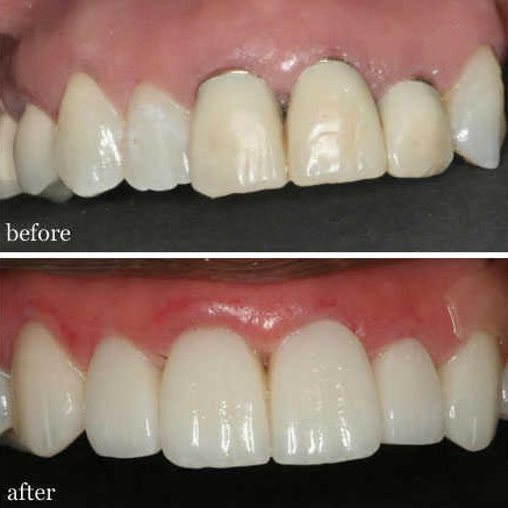 Before and After | Greenville Dentist