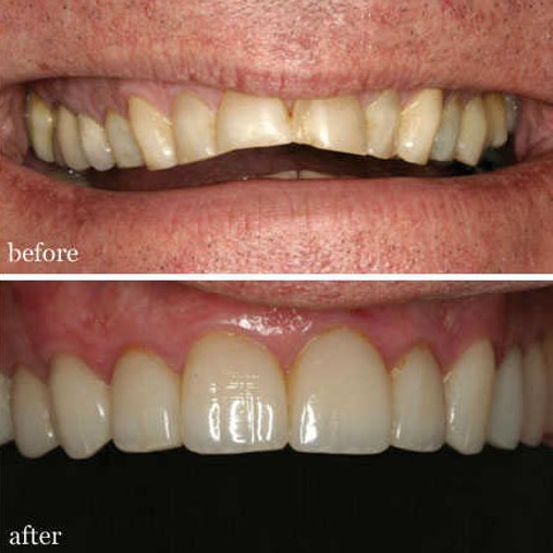 Before and After | Greenville Dentist
