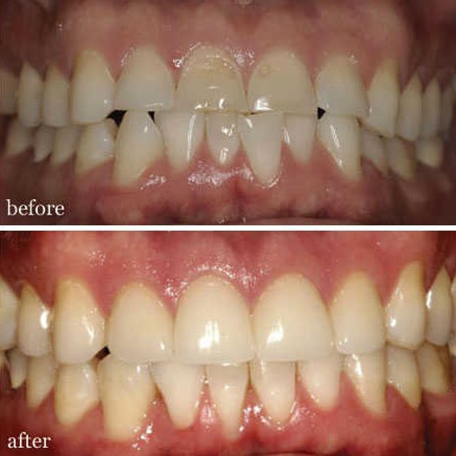 Before and After | Greenville Dentist